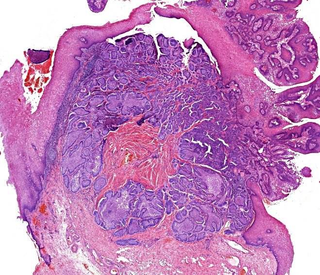 Clinicopathological Pearl: Ameloblastom - MVZ Dermatohistopathologie ...